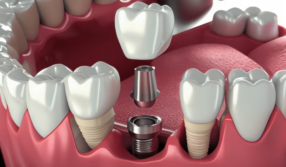 Ringing in Your Ears After Dental Implants? Here's What You Need to Know
